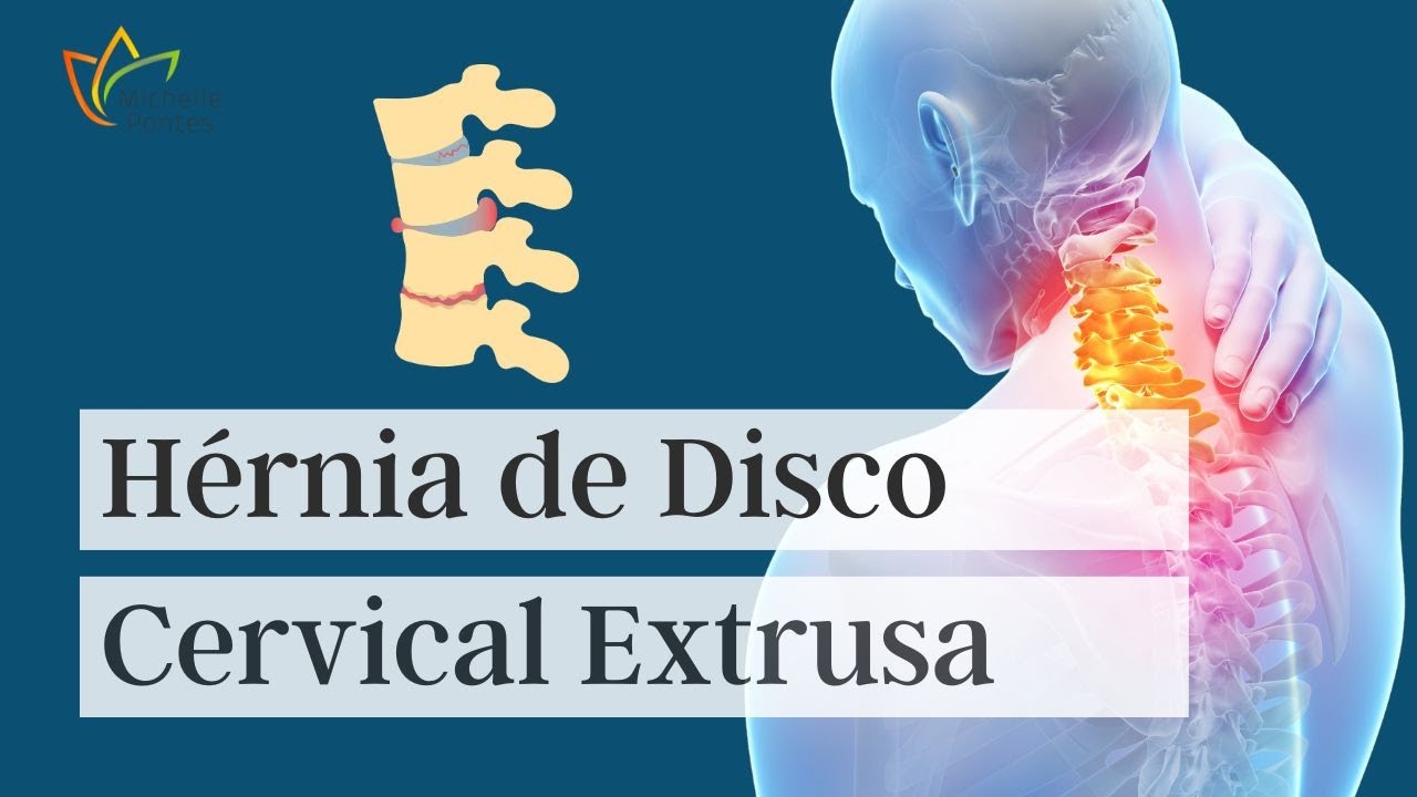 Hérnia de Disco Cervical Extrusa! - YouTube