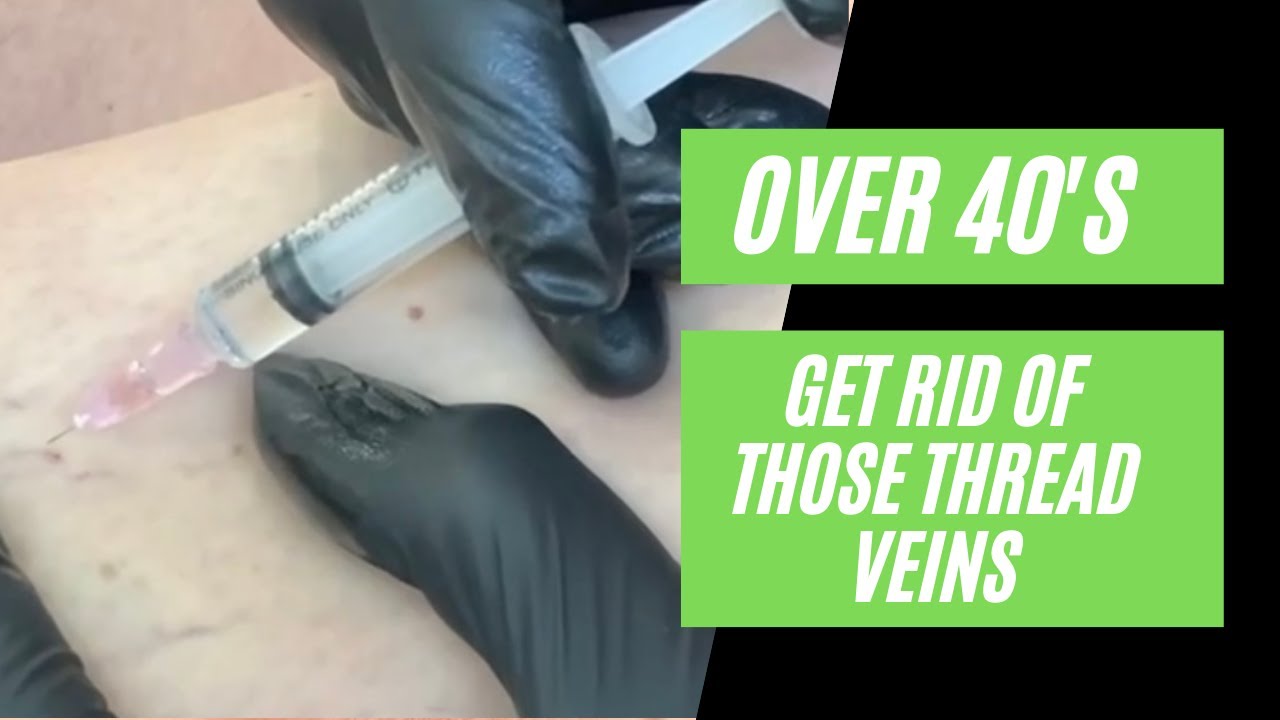 How To Remove Thread And Spider Veins YouTube how-to-remove-thread-and-spider-veins-youtube