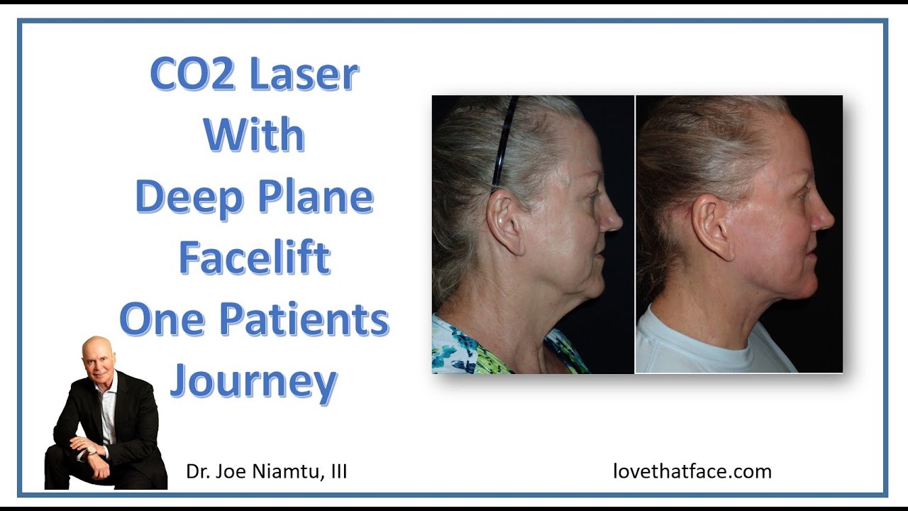 CO2 Laser with Deep Plane Facelift: Following a patients recovery - YouTube