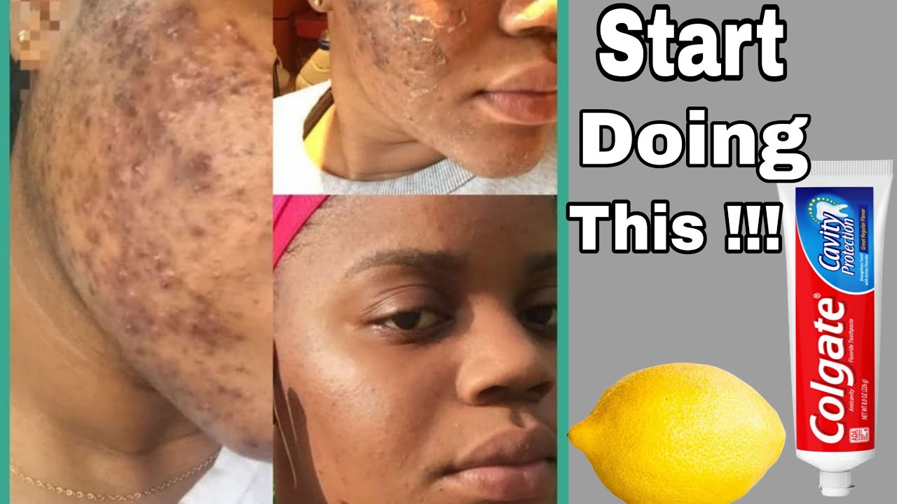 Use Toothpaste this way to remove pimples and acne/works 100% #skincare ...