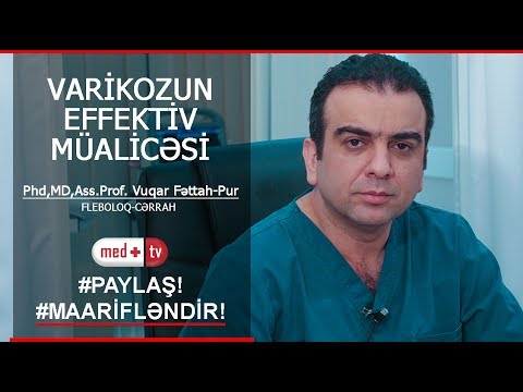 Varikozun effektiv mualice usulu - Prof  Dr. Vuqar Fettah Pur Cerrah Fleboloq