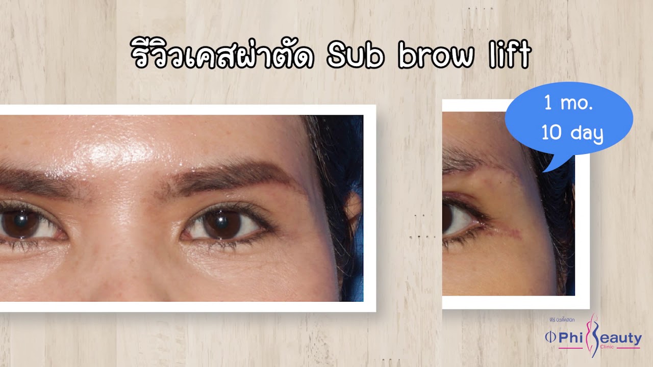sub brow lift ยกหางตา ชั้นตาสวย เป็นธรรมชาติ By Phi beauty clinic - YouTube