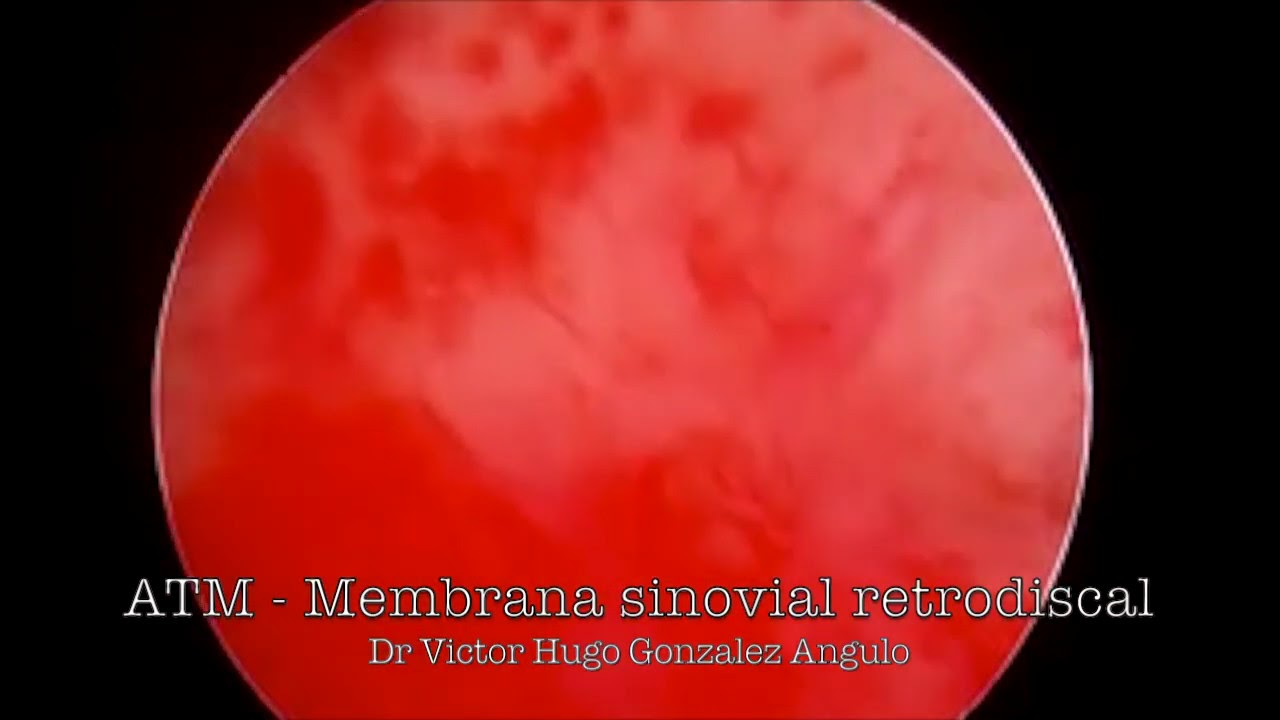 Retrodiscal Zone TMJ Arthroscopy anatomy - Anatomia artroscopica de la ...