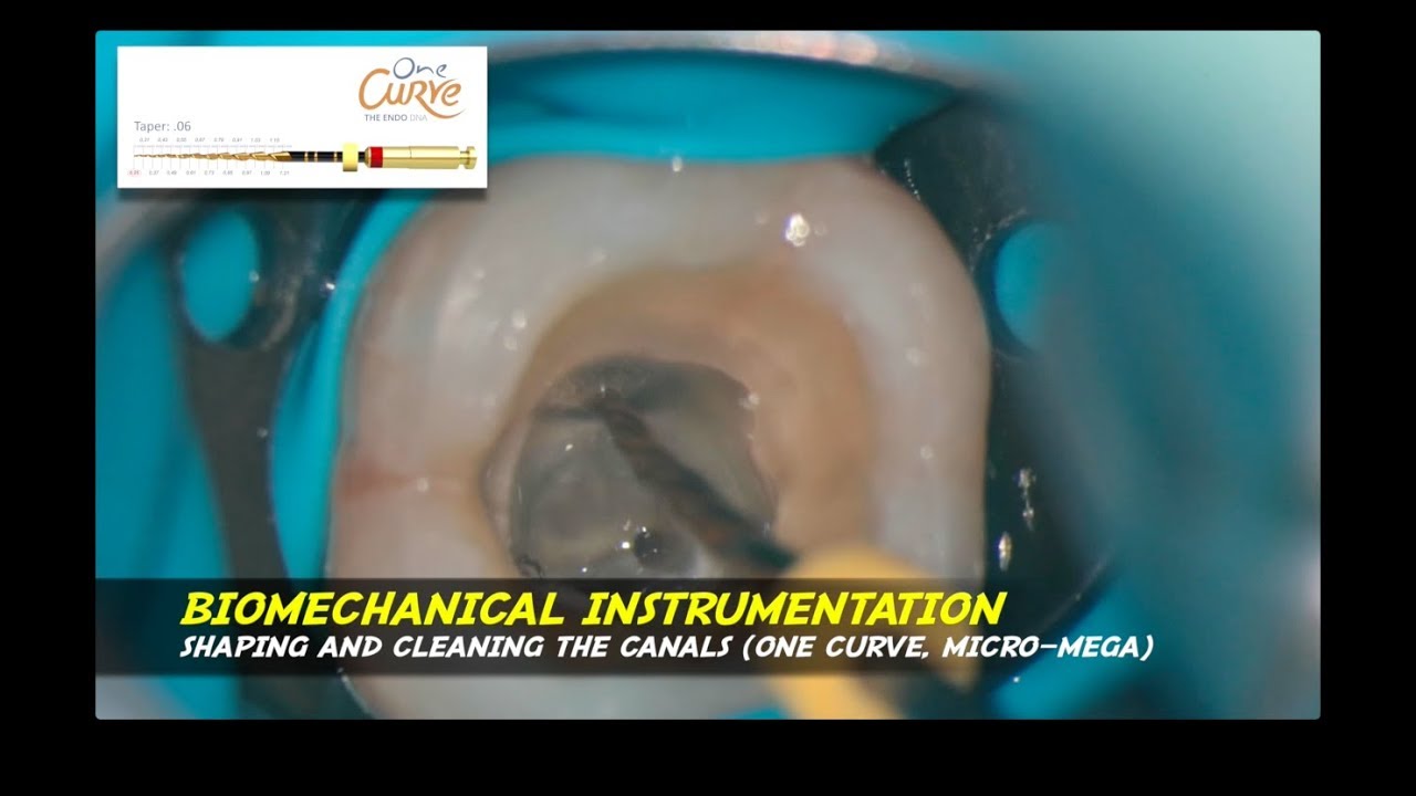 endodontic treatment continuous wave obturation one curve micro-mega ...