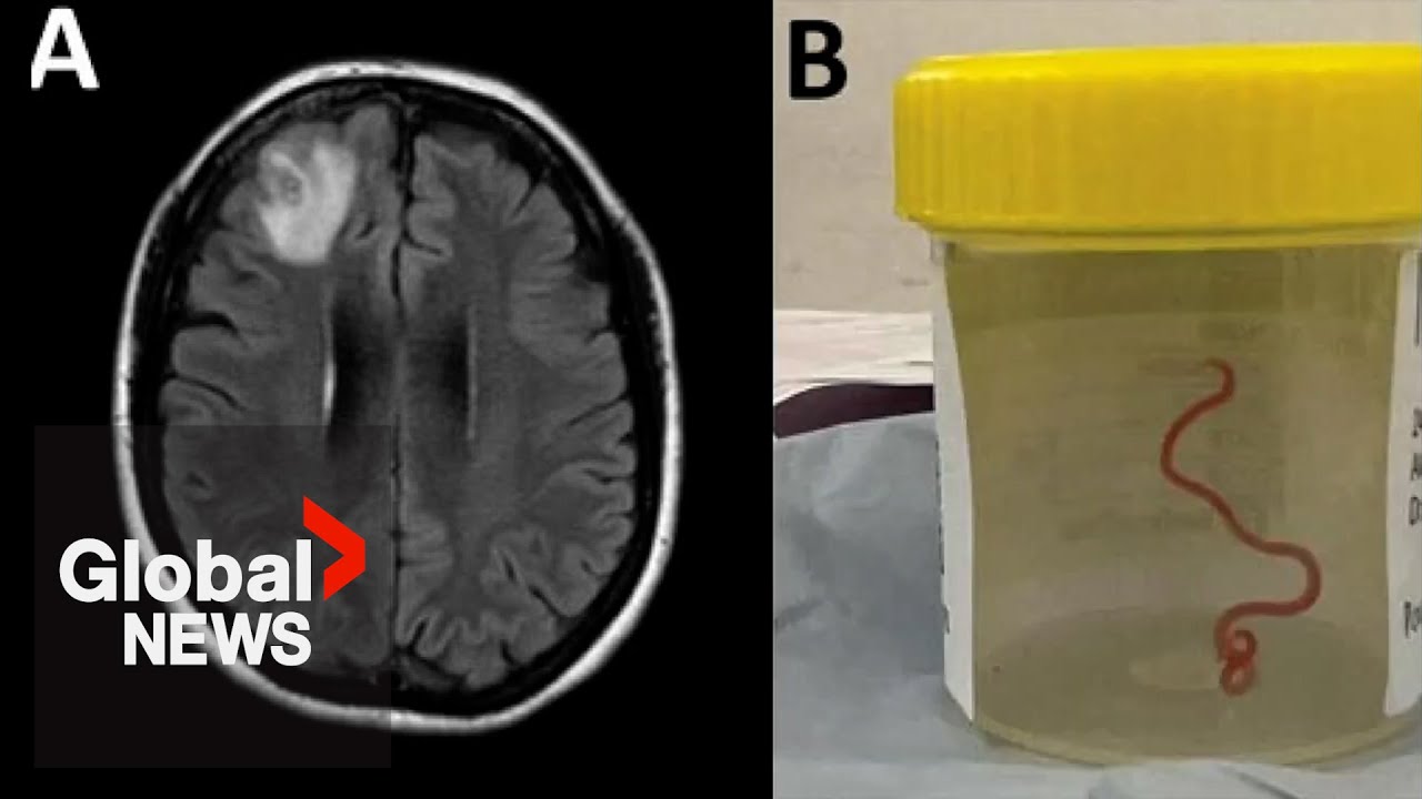 Doctors pull wriggling 8-centimetre live worm from patient’s brain during surgery - YouTube
