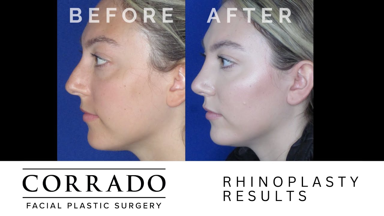 post-op-septoplasty-and-rhinoplasty-patient-testimonial-dr-corrado