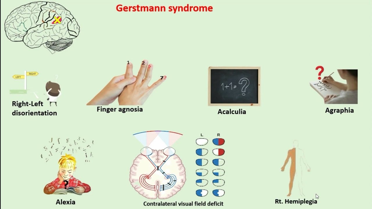 Gerstmann syndrome | Alexia with Agraphia | angular gyrus - YouTube