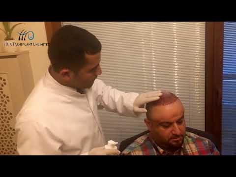 Washing hair after transplant     Ekimden sonra saç yıkamak