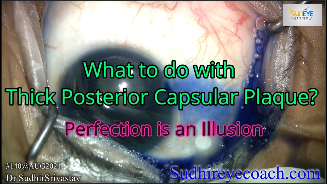 WHAT TO DO WITH POSTERIOR CAPSULAR PLAQUE - YouTube