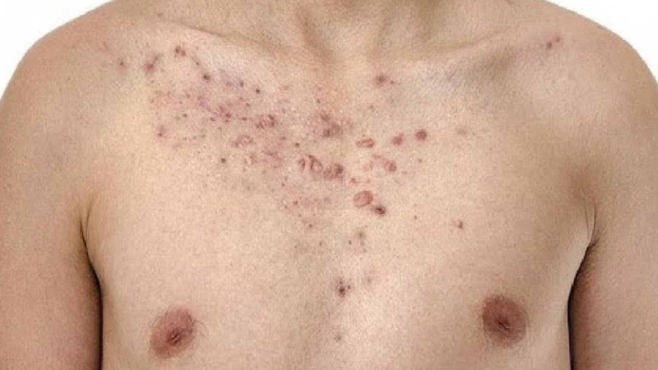 REMOVE CHEST AND BACK ACNE BY DOING THIS RIGHT NOW - YouTube