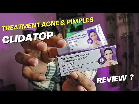 Clindatop Acne Treatment Gel EXPOSED Is It Really Effective? - YouTube