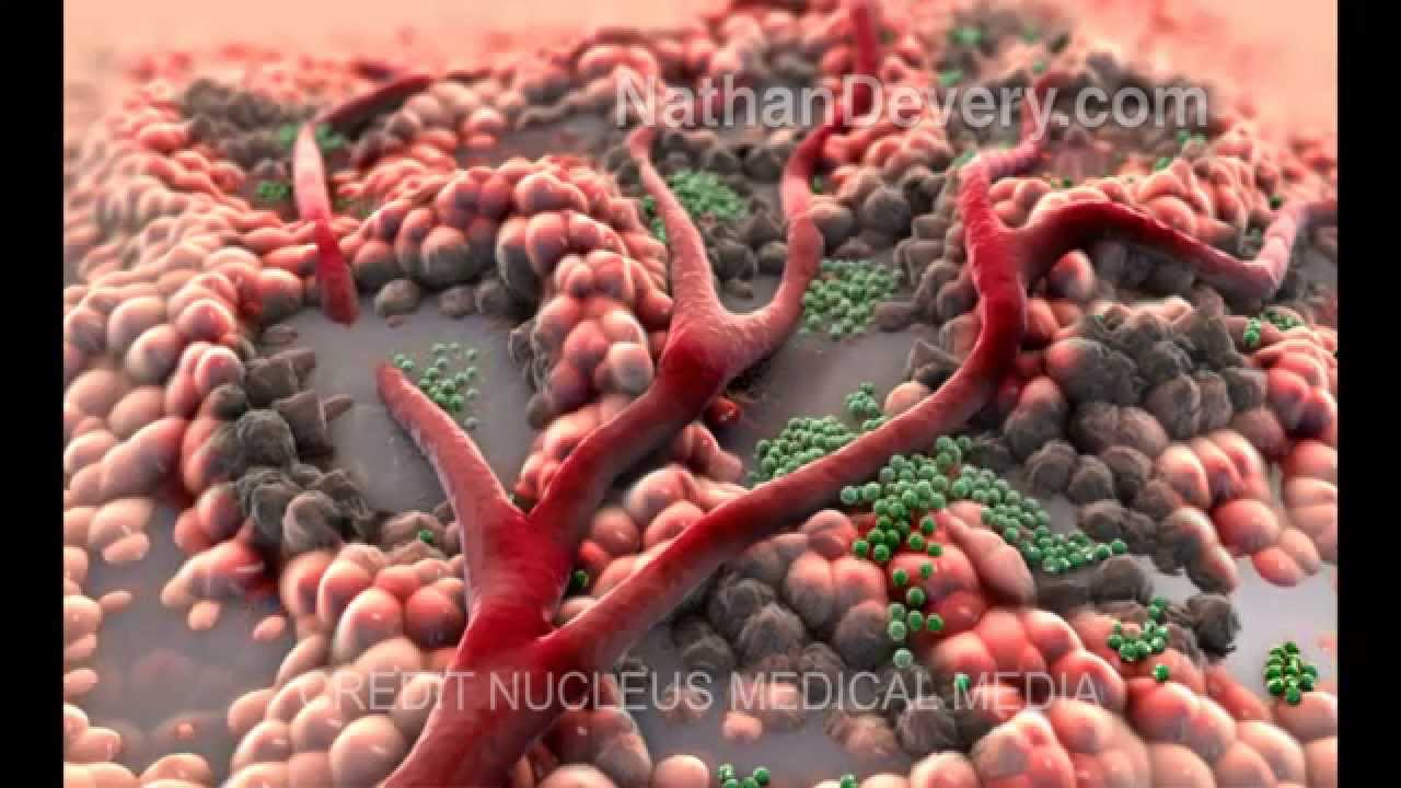 Staph Infection medical animation - YouTube
