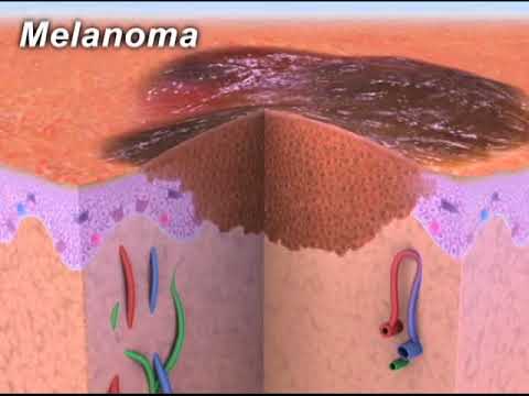 Skin cancer - How skin cancer develops - YouTube