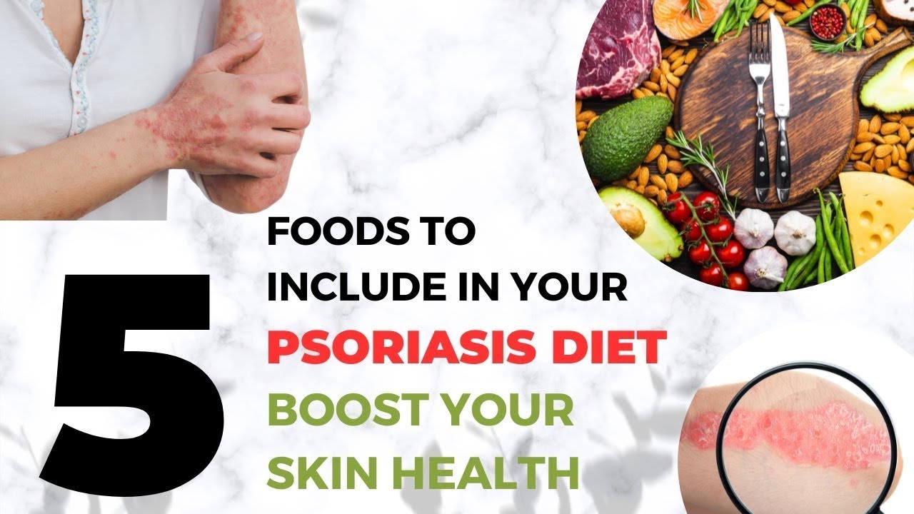 Top 5 Foods || Include in Your Psoriasis Diet to Boost Your Skin Health ...