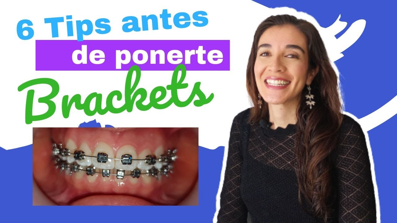 6 Tips antes de ponerse BRACKETS - YouTube