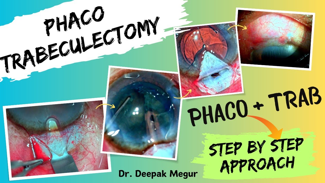 Phacotrabeculectomy - Step by step approach (Single site phaco trab ...