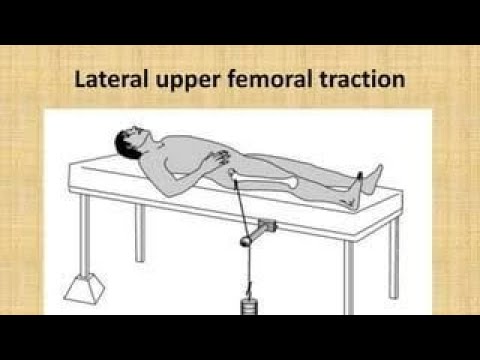 UPPER FEMORAL SKELETAL TRACTION LIVE || HOW TO APPLY UPPER FEMORAL ...