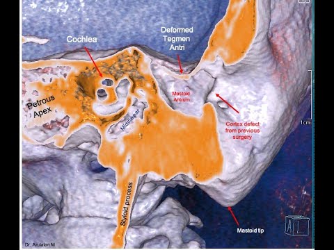 Trans-mastoid Repair of Tegmen Antri defect and LSCC fistula - YouTube