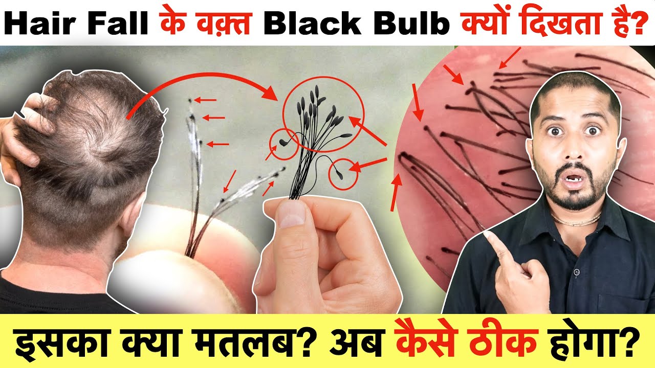 Hair Fall with Black Bulb Explained: Causes & Solutions for Healthy ...