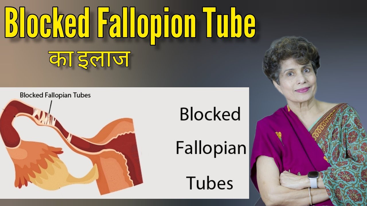 क्या Blocked Fallopian Tube के इलाज में Laparoscopy Surgery करवाना ...