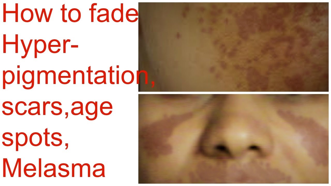 HOW TO REMOVE PIGMENTATION FROM FACE NATURALLY | Fade dark spots ...
