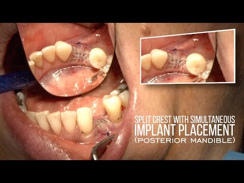 Split Crest Technique with Simultaneous Implant Placement (Posterior ...