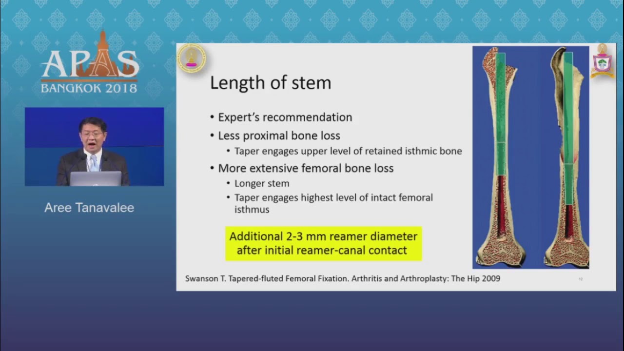 Femoral revision using tapered fluted stem: Is stem length issue ...