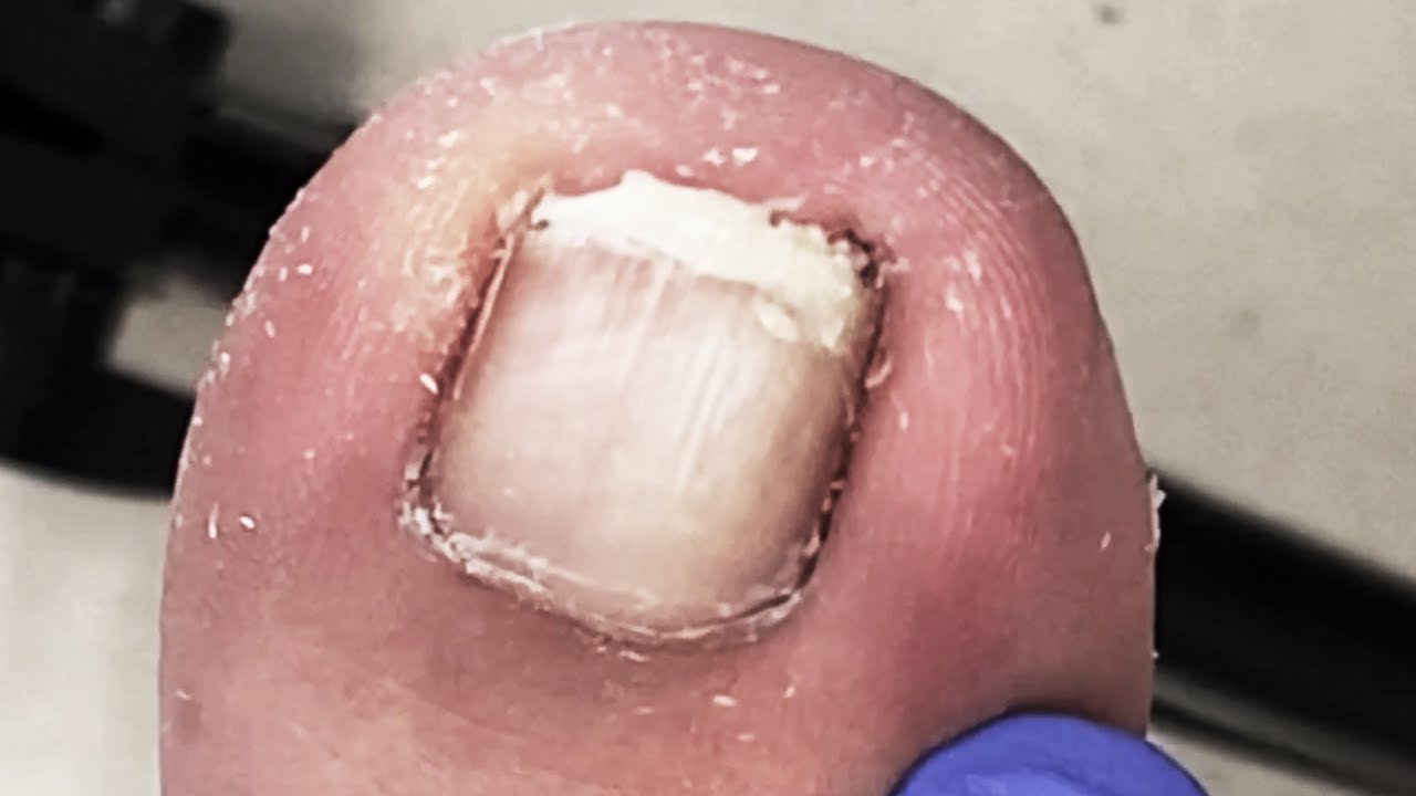 I'm happy as soon as the ingrown nails are dug out,and it's very stress ...