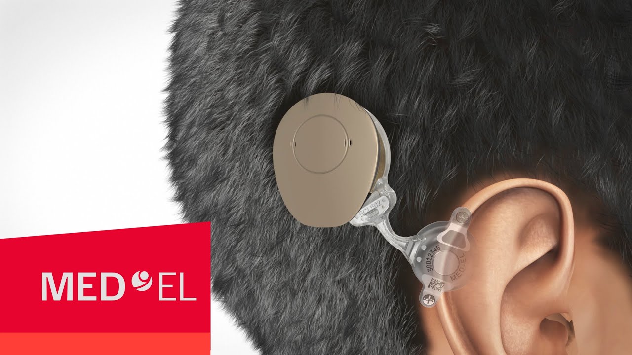 How the BONEBRIDGE Bone Conduction Implant Works With SAMBA 2 - YouTube