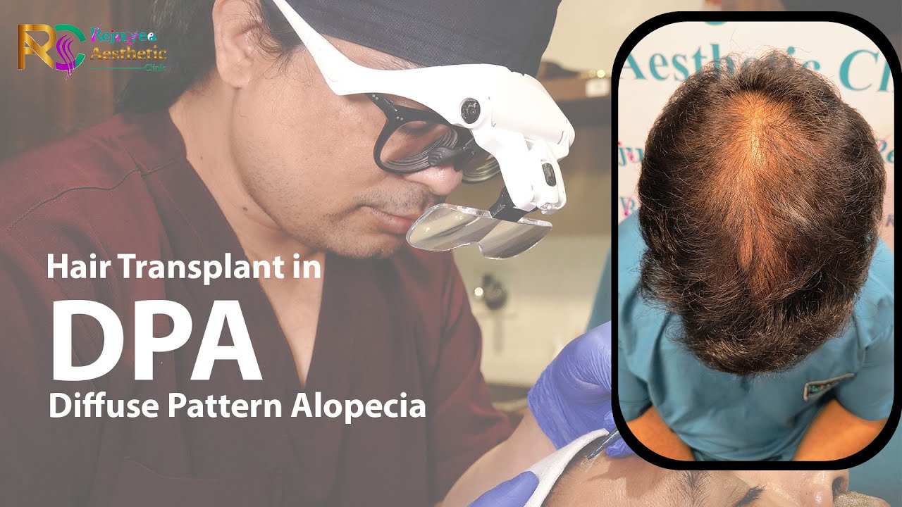 Hair Transplant in Diffuse pattern Alopecia | DPA #drsantoshingle - YouTube