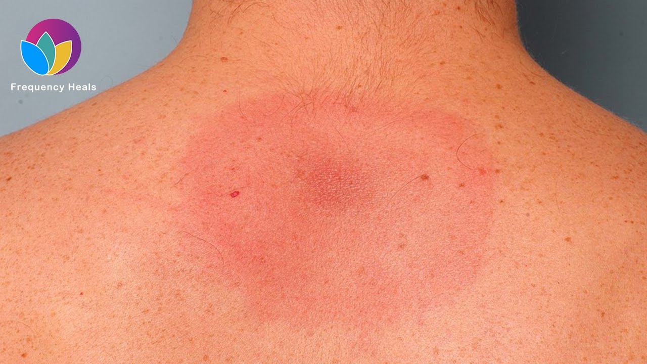 Lyme Disease Healing Frequency | Remove the Pathogens & Relieve Pain ...