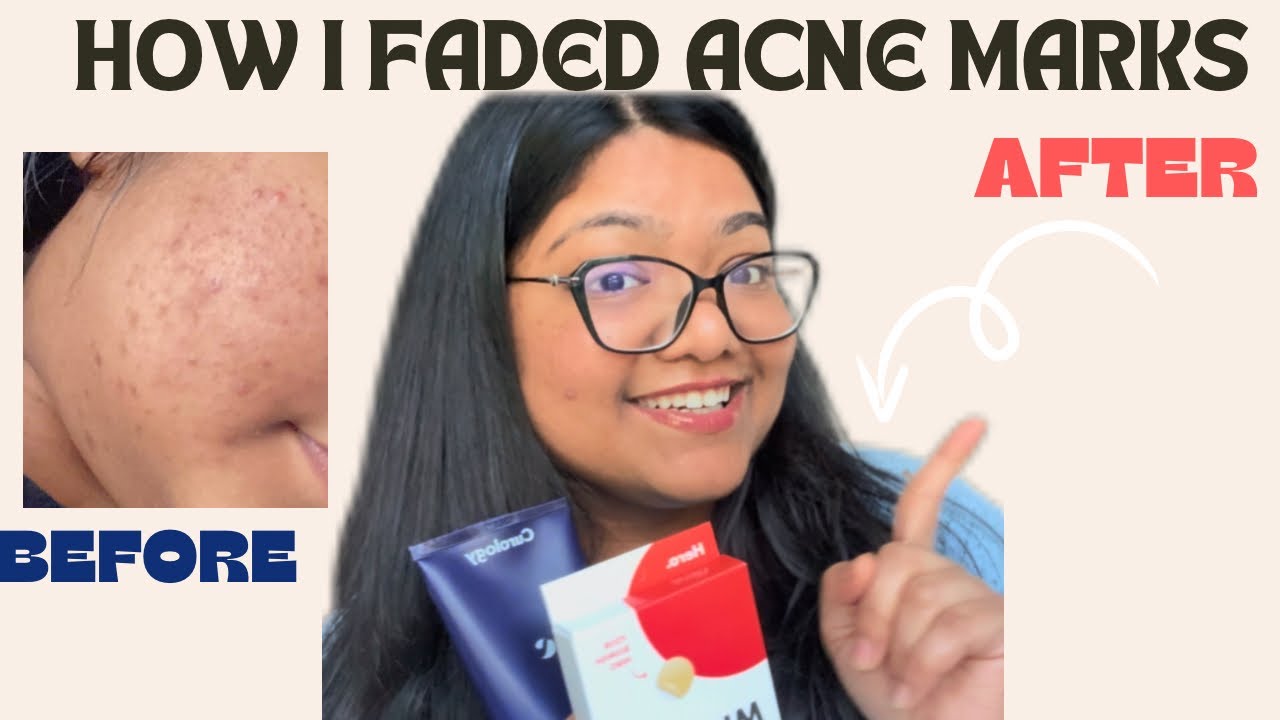 Acne Gone in 5 Days😦😳 - YouTube