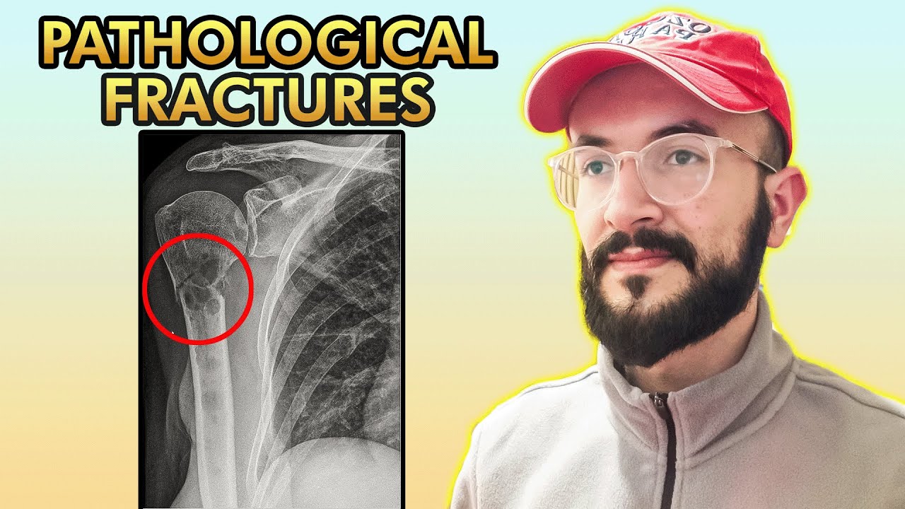 Pathological Fractures: X ray Imaging, Clinical Features and Treatment ...