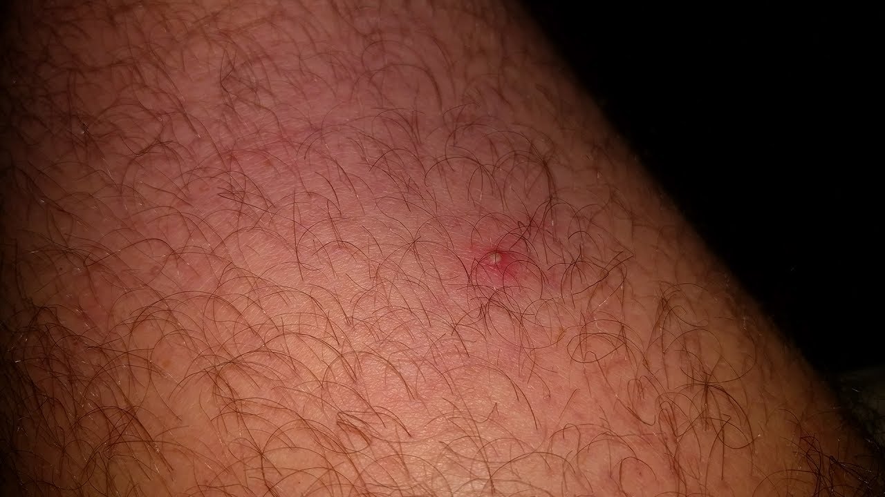 Zit on leg - YouTube