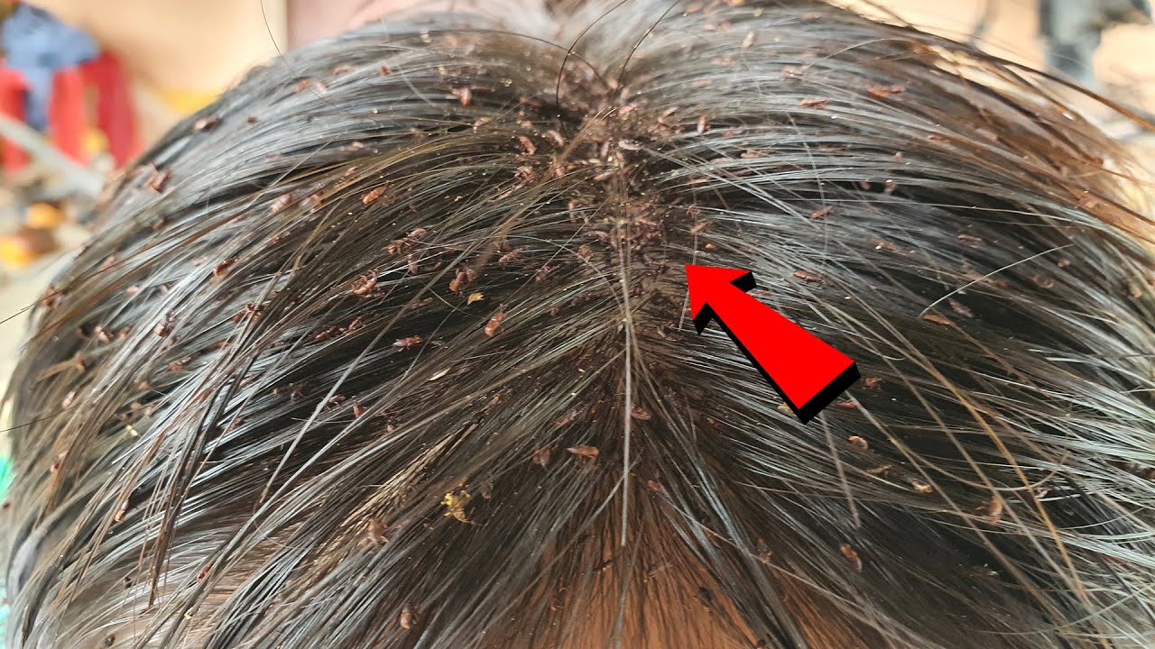 Giant Lice Removal Easy way to remove thousand lice at home - YouTube