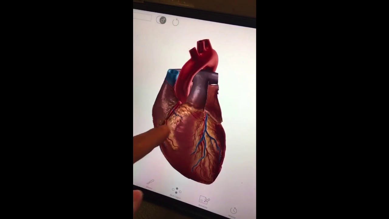 What Exactly are Heart Attacks? (Explained in 30 Seconds with Diagrams ...