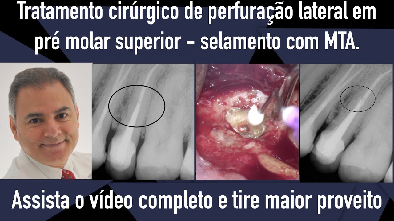 Tratamento cirúrgico de perfuração lateral e selamento com MTA - YouTube