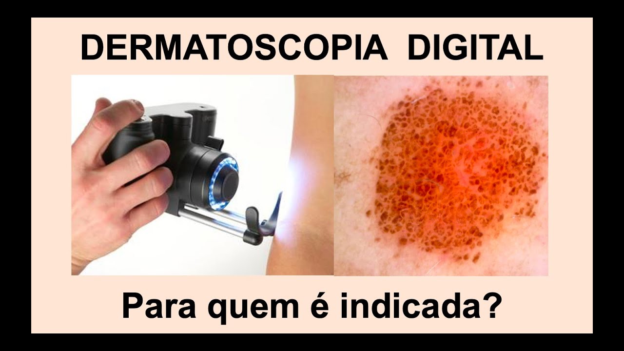 DERMATOSCOPIA DIGITAL - O que é este exame? Para quem está indicado ...