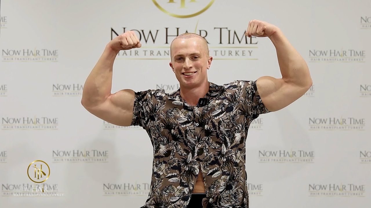 Hair Transplant Journey! @seanfitzness - YouTube