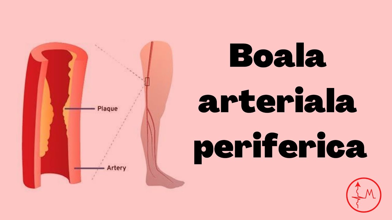 Boala arteriala periferica | BAP - YouTube