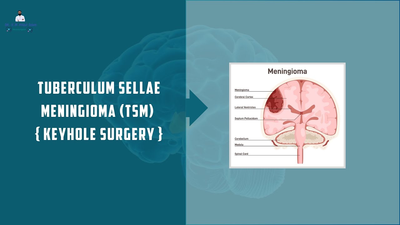 Tuberculum Sellae Meningioma (TSM) Keyhole Surgery: A Minimally ...