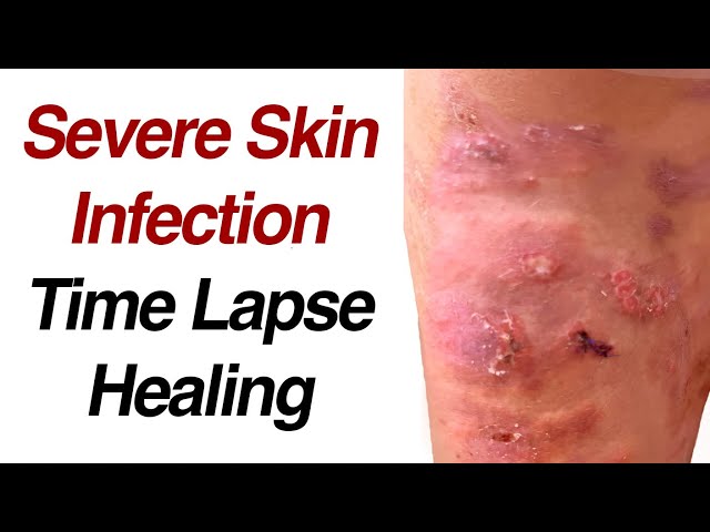Staph Skin Infection