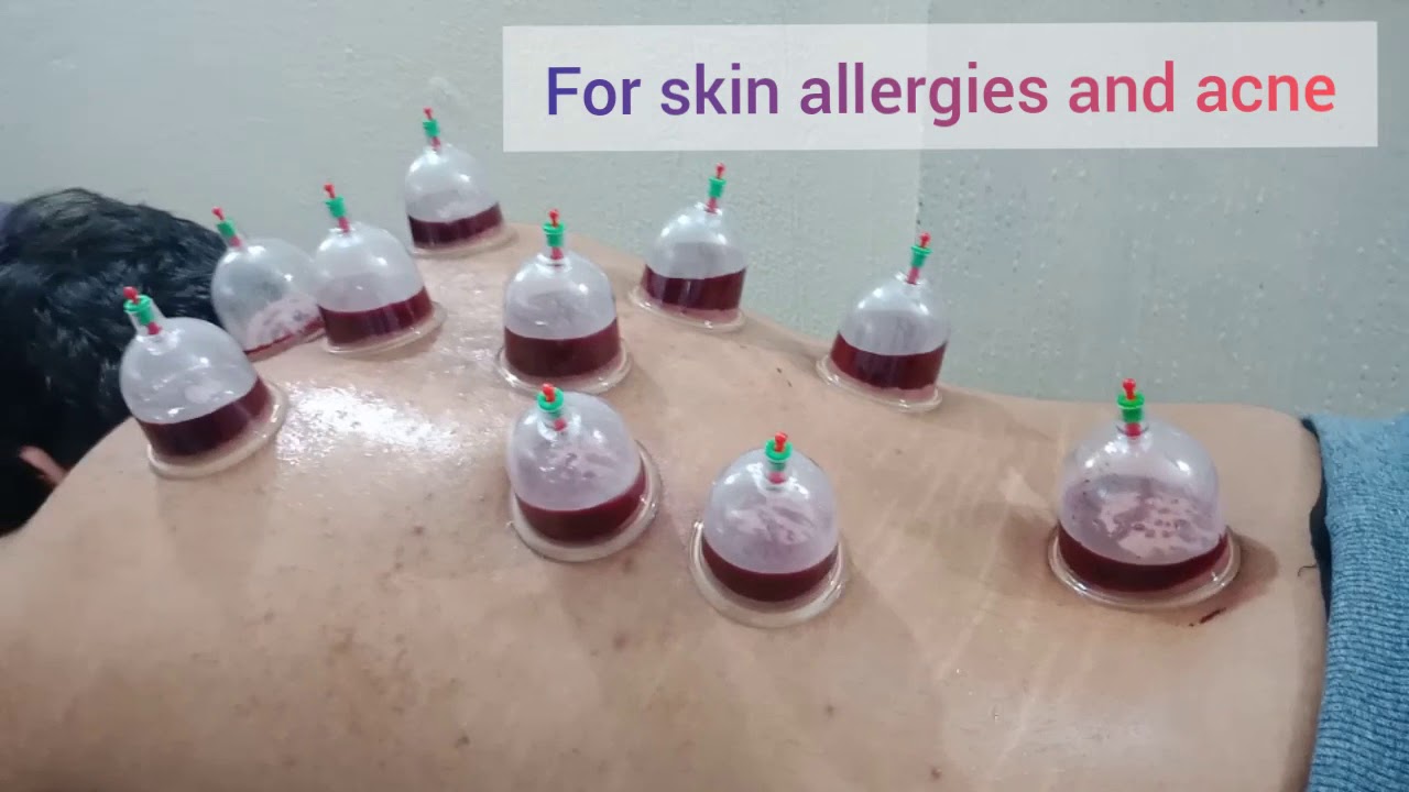 SKIN DISORDERS, ACNE AND ALLERGIES TREATMENT WITH HIJAMA OR CUPPING ...