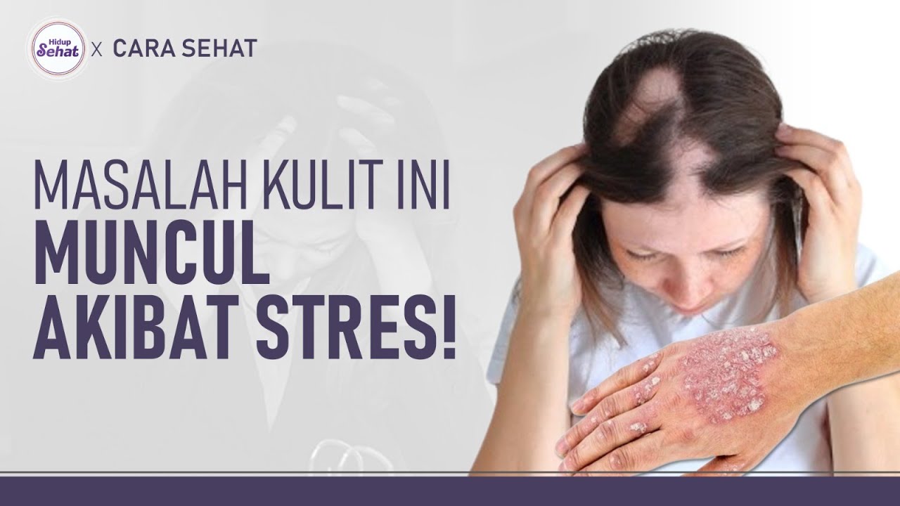 Stres Bisa Picu Penyakit Kulit? Ini Mitos dan Faktanya | Hidup Sehat ...