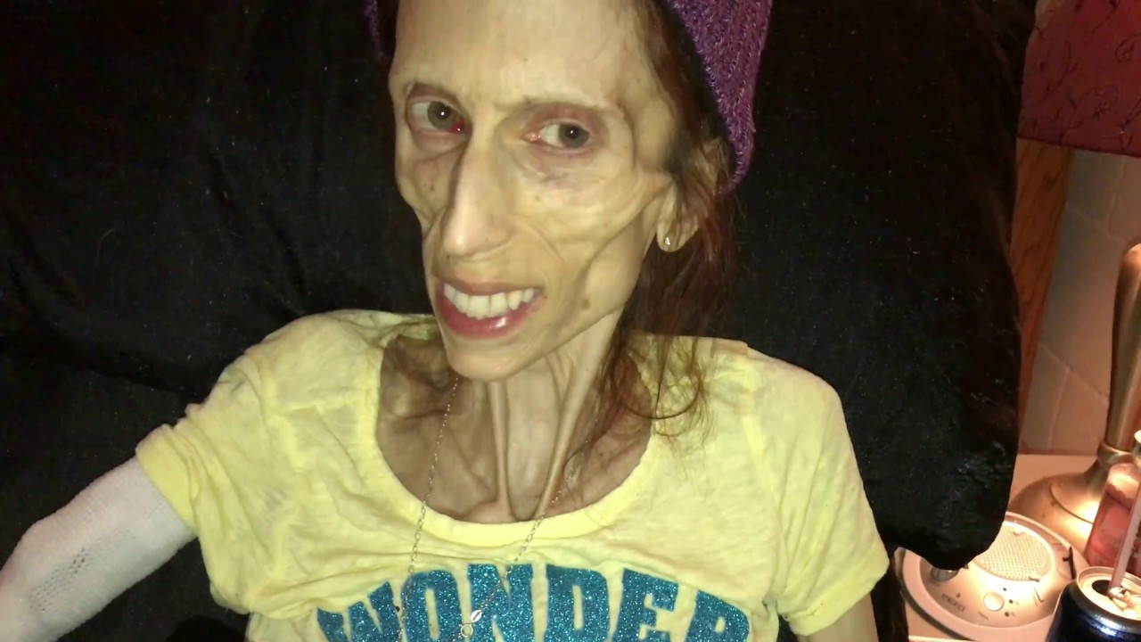 One of RaCHael’S Worst Stages of ReCoVeRY From Anorexia.. 😢 - YouTube