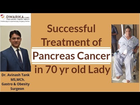Pancreas Cancer: Anatomy, Functions, and Risks
