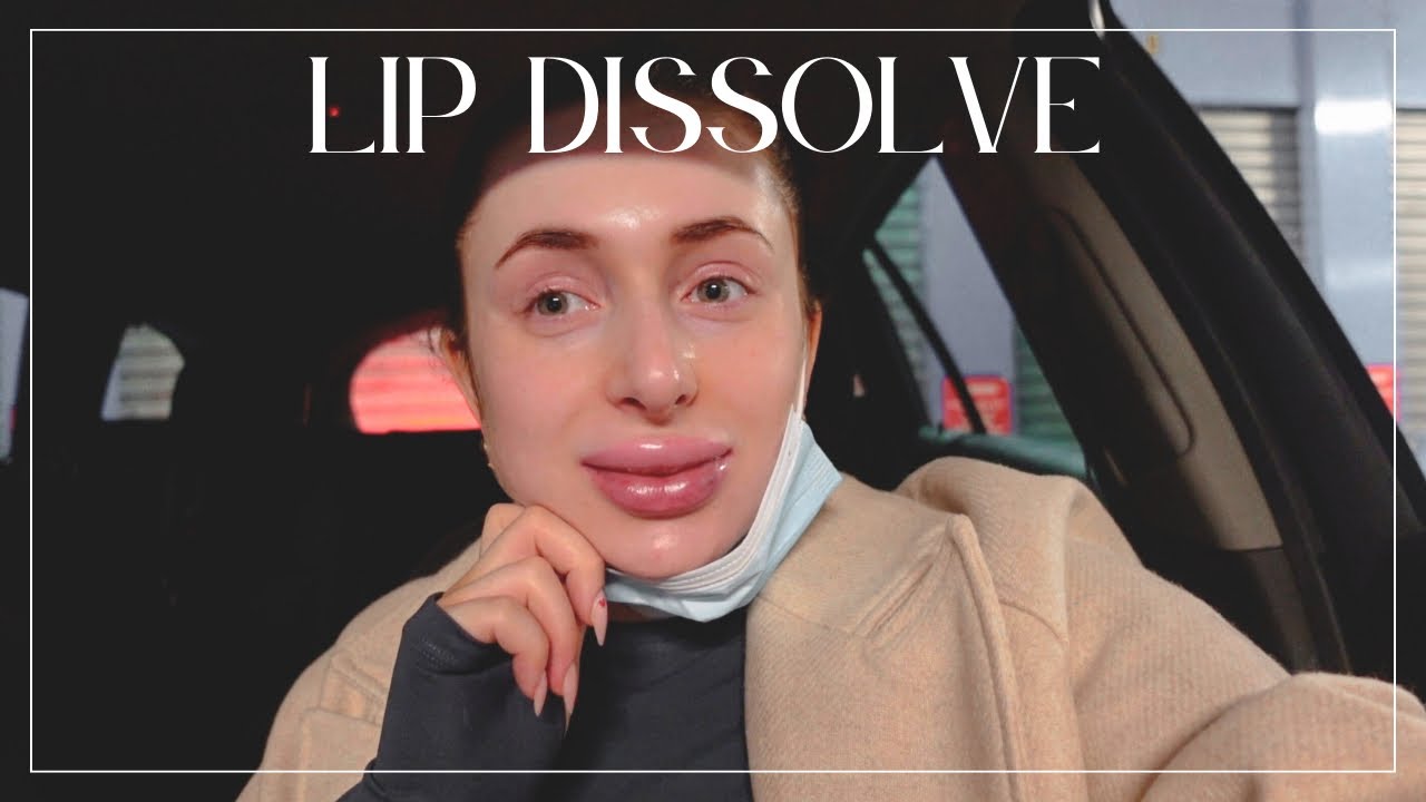 I GOT MY LIP FILLER DISSOLVED TWICE *omg* | dissolve & re-fill process ...