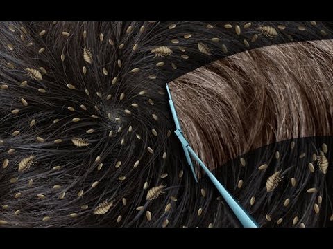 Cara Menghilangkan Telur Kutu dengan Cuka yang Aman dan Alami - YouTube