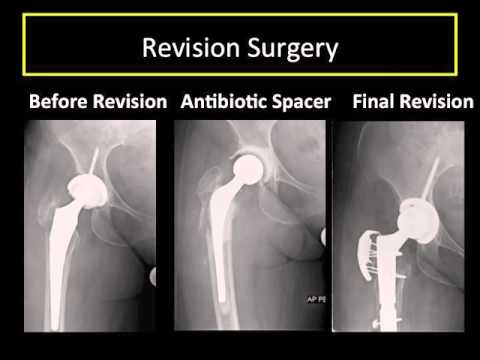 How Do They Redo A Hip Replacement