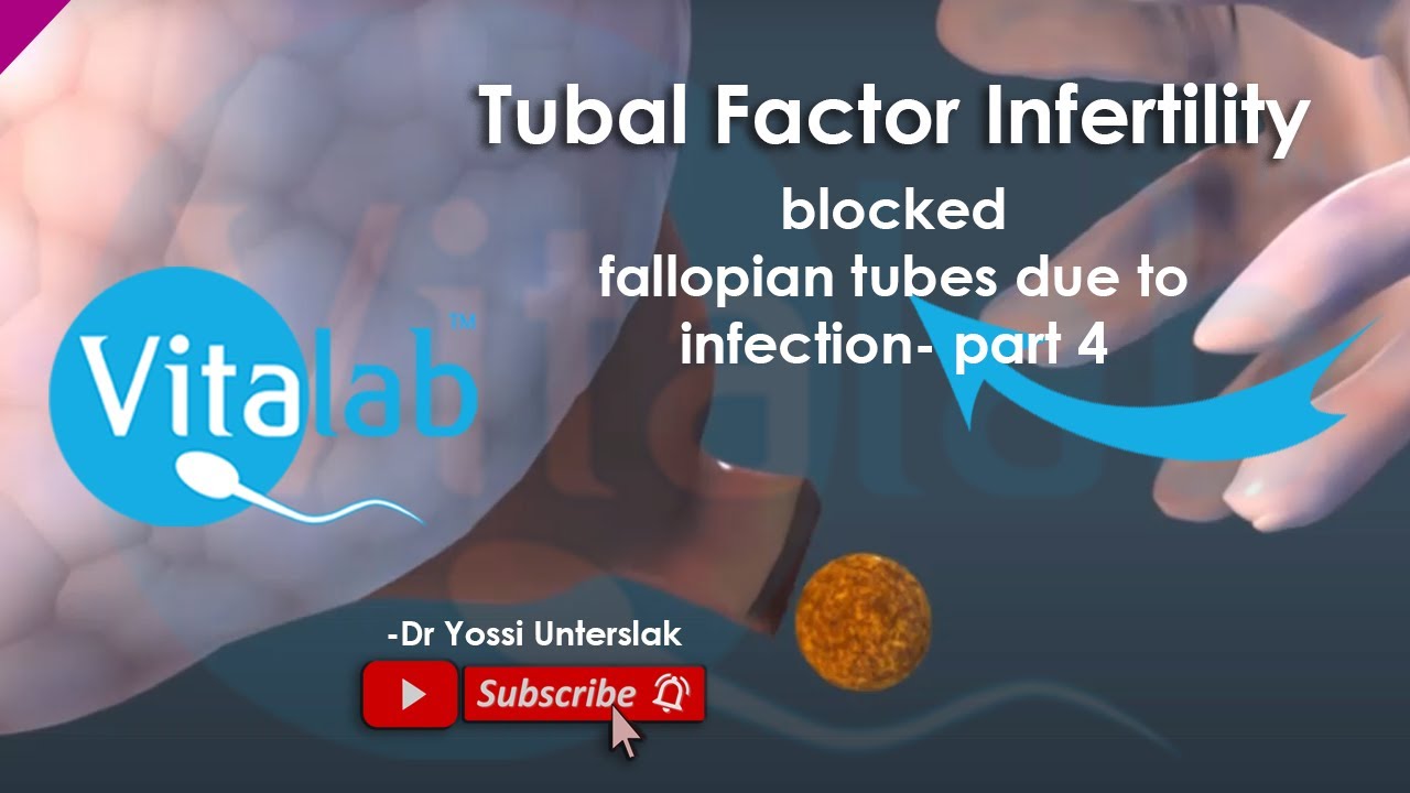 Tubal Factor Infertility- Blocked Fallopian Tubes due to Infection ...